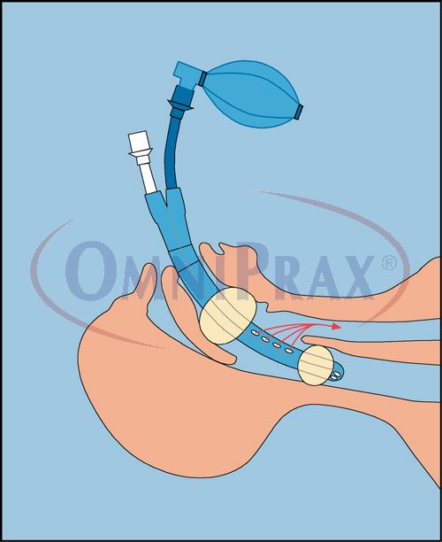 OmniPrax - KOMBI TUBUS